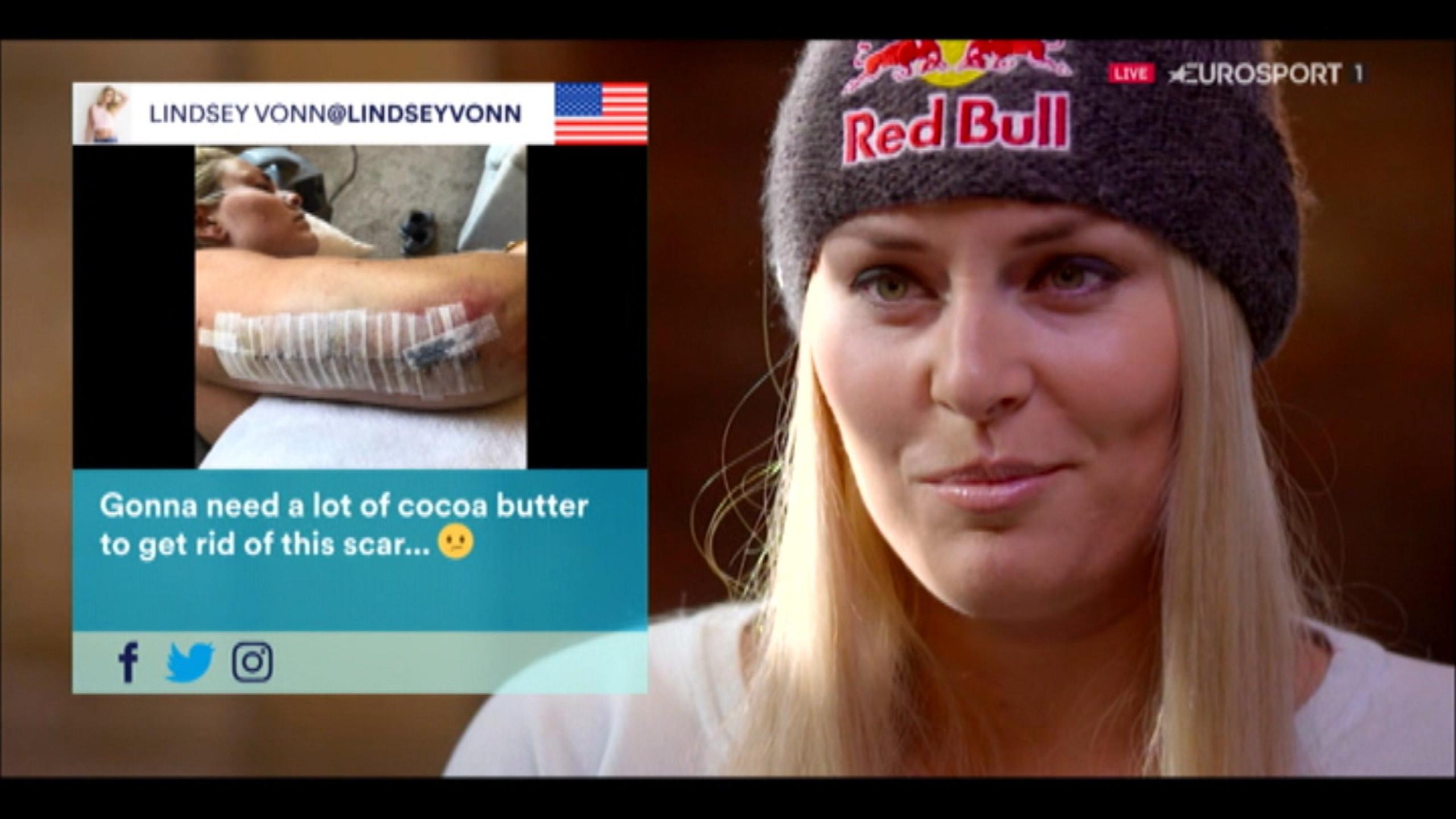 Lindsey Vonn This Is One Of The Most Painful Injuries I Have Ever Had lindsey-vonn-this-is-one-of-the-most-painful-injuries-i-have-ever-had