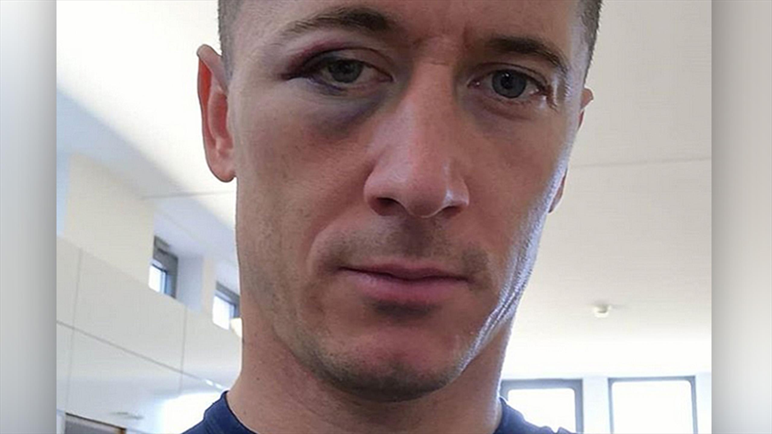 Liga Mistrzów. Lewandowski pokazał podbite oko po Sevilli - Eurosport